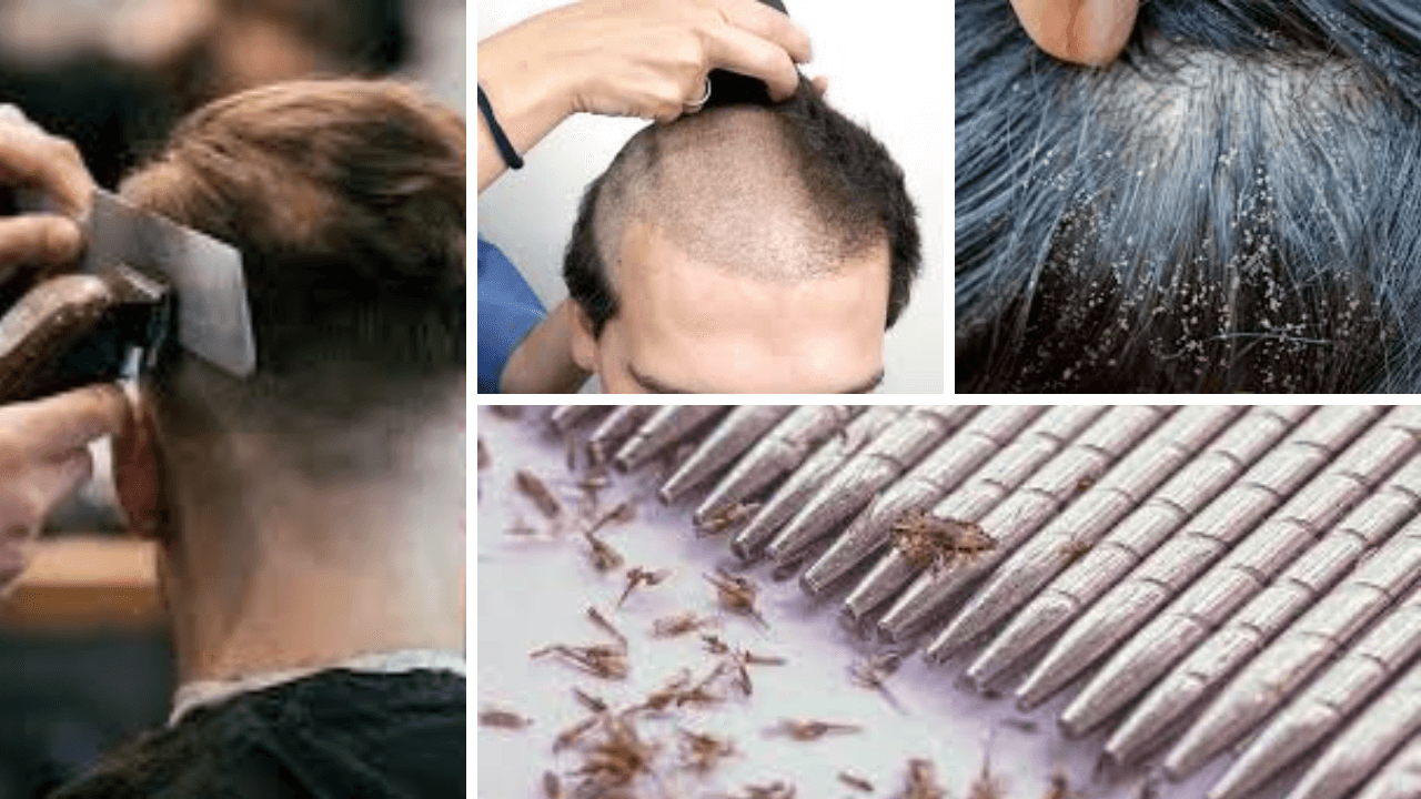 Does Shaving Your Head Bald Get Rid of Lice? Scary Truth!